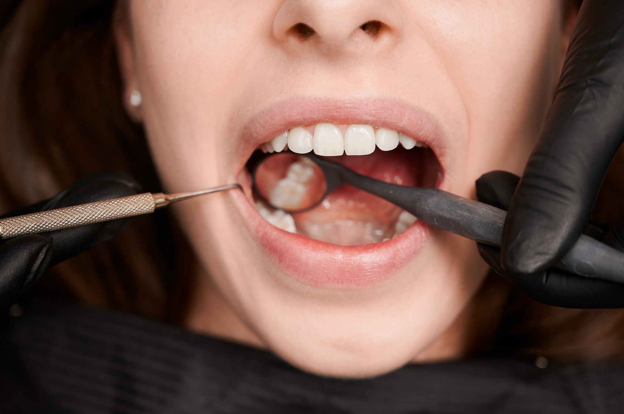 Tooth Removal in Abu Dhabi | Expert Tooth Extraction Services UAE